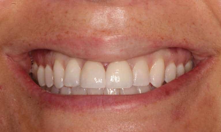 Smile Gallery – Raleigh, NC – Cameron Village Dentistry